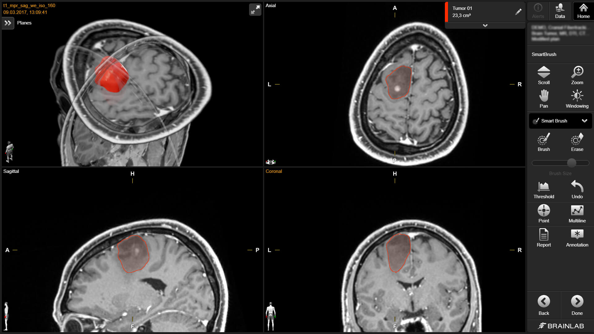 Cranial Planning with Elements: Software for Neurosurgery | Brainlab